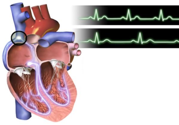 Bradycardia Slow Heart Rate | Symptoms, Diagnostics, Causes, Treatment