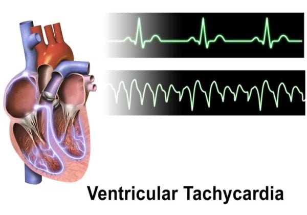 Tachycardia fast heartbeat | Symptoms, Diagnostics, Causes, Treatment