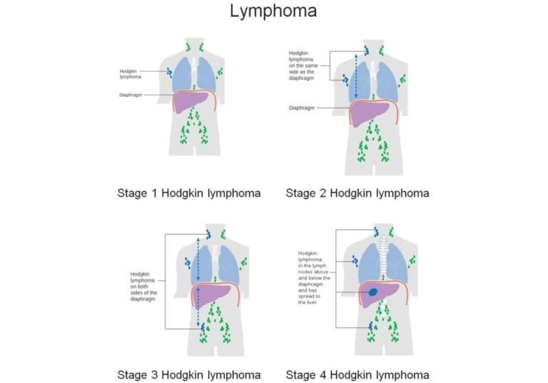 Lymphoma, Hodgkin and Non Hodgkin | Symptoms, Stages, Treatments