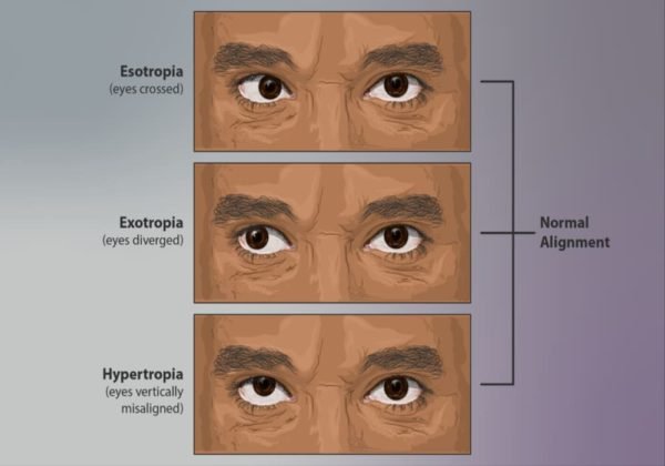 Strabismus (crossed eyes: esotropia, extropia, hypertropia) | Treatment