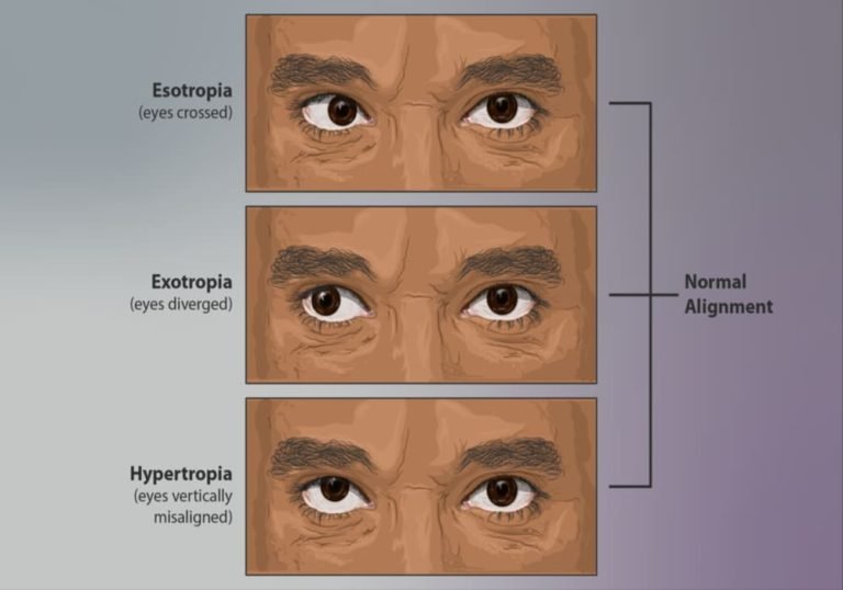Strabismus (crossed eyes: esotropia, extropia, hypertropia) | Treatment