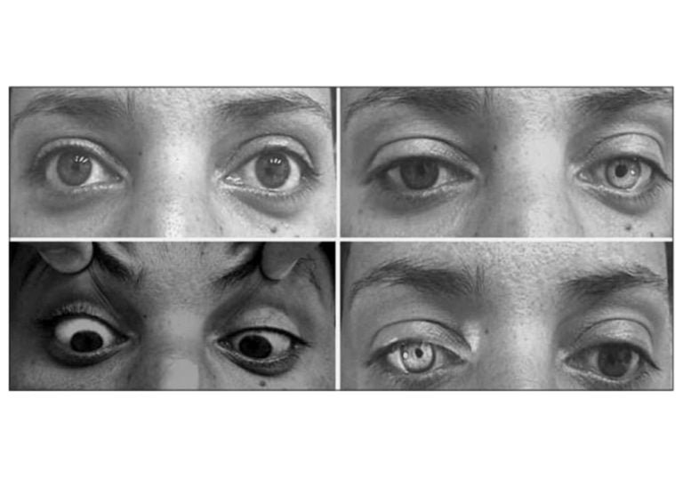 Argyll Robertson Pupil | The pupillary response to light is weak