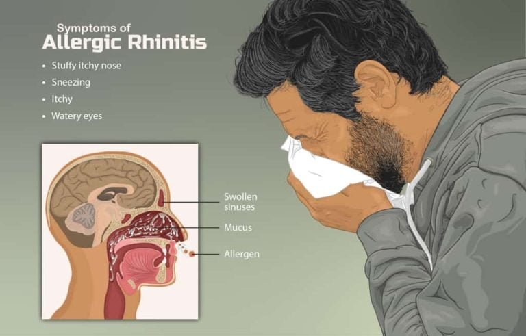 Allergic Rhinitis Symptoms Causes Treatments And Prevention